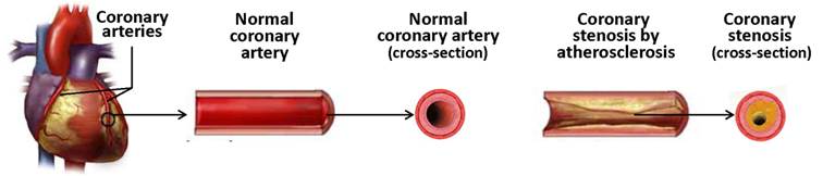 Nanoparticle Drug- and Gene-eluting Stents for the Prevention and ...