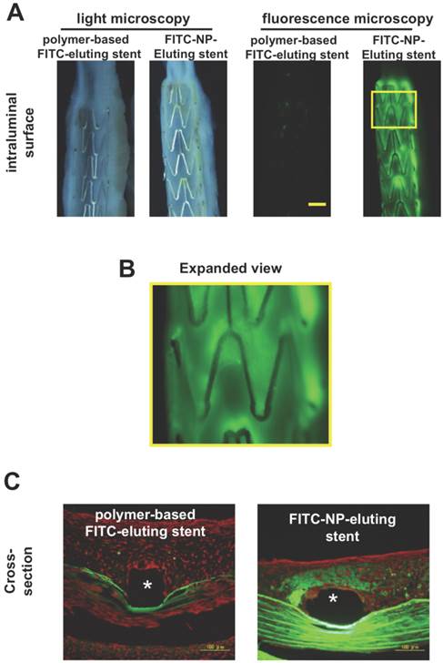 Bioabsorbable Stent Quo Vadis: A Case for Nano-Theranostics