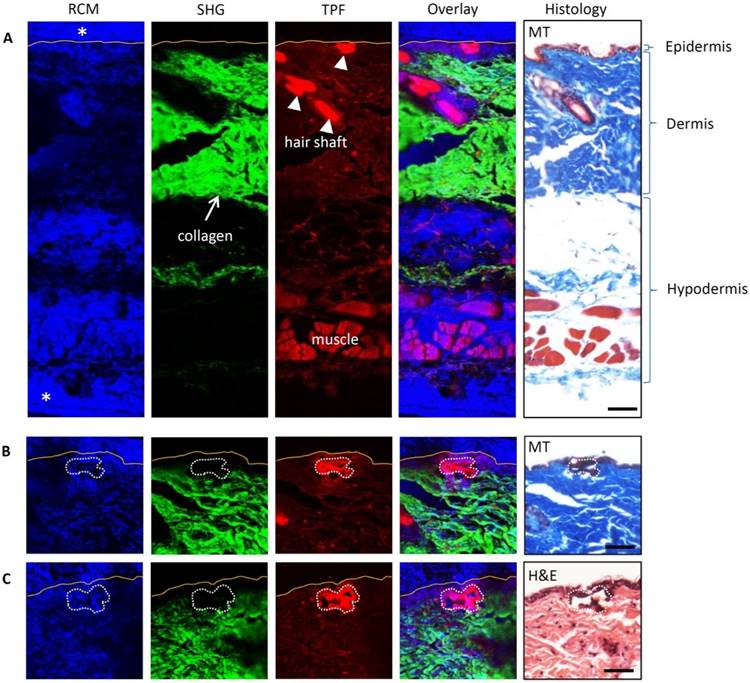 Precise Spatially Selective Photothermolysis Using Modulated ...