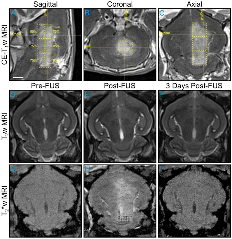 Three-dimensional transcranial microbubble imaging for guiding ...