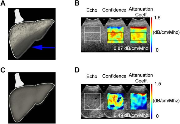 Quantitative ultrasound approaches for diagnosis and monitoring hepatic ...
