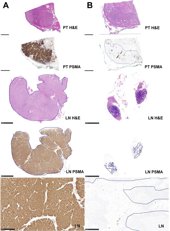Immunohistochemical PSMA expression patterns of primary prostate cancer ...