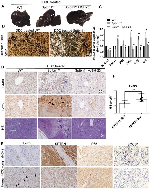 SPTBN1 inhibits inflammatory responses and hepatocarcinogenesis via the ...