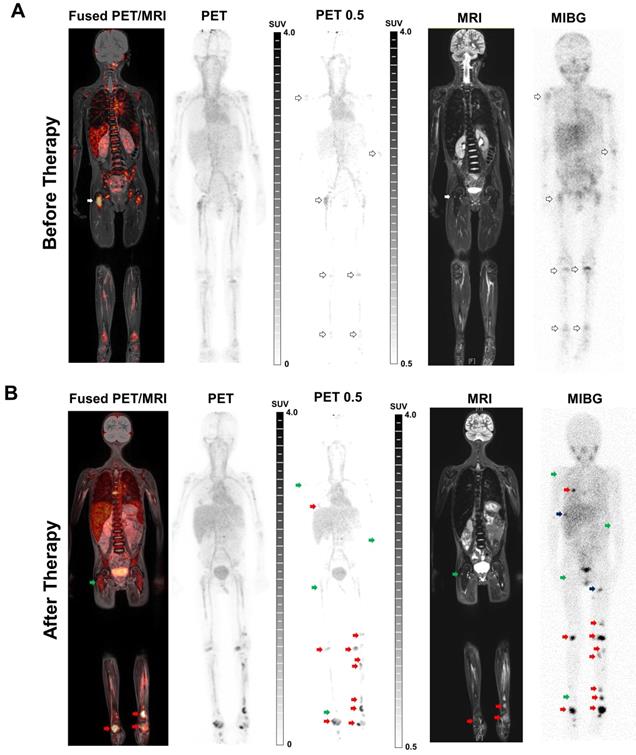 Translational immunoPET imaging using a radiolabeled GD2-specific ...