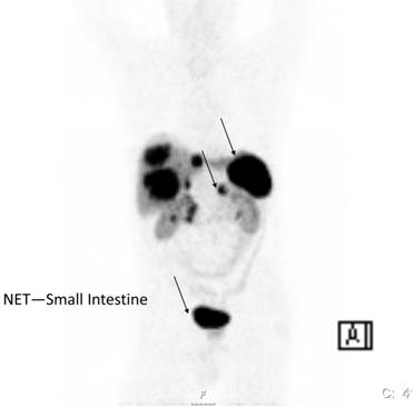 Octreotide Scan