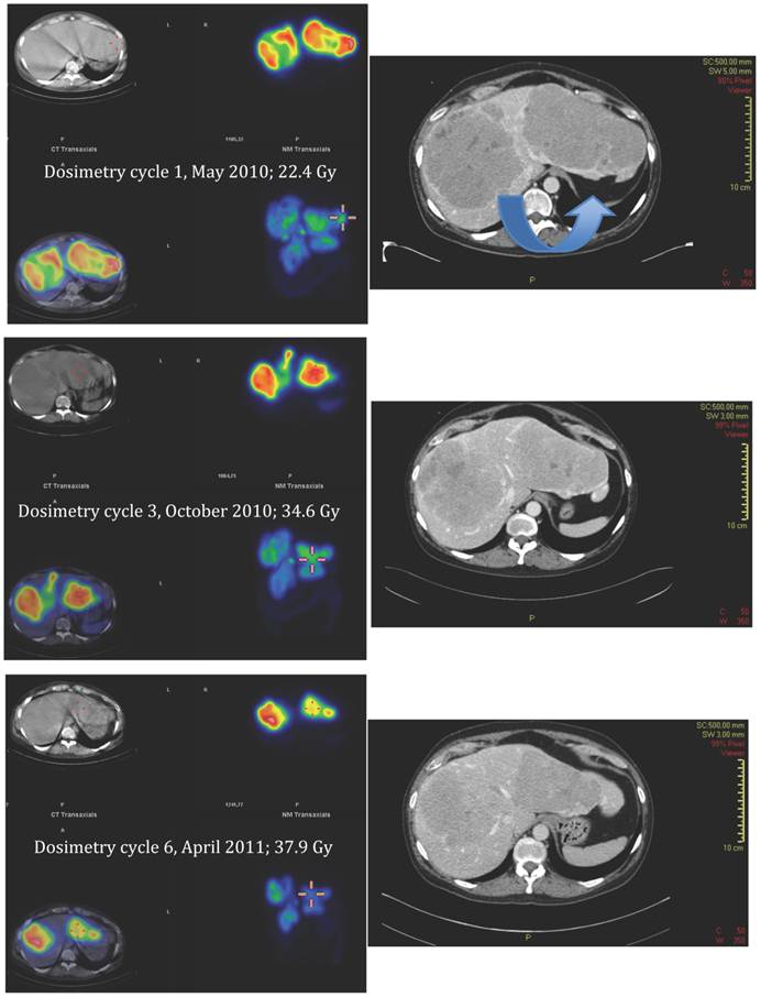 Lessons on Tumour Response: Imaging during Therapy with 177Lu-DOTA ...