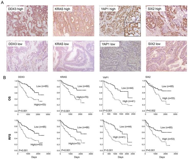 The YAP1/SIX2 axis is required for DDX3-mediated tumor aggressiveness ...