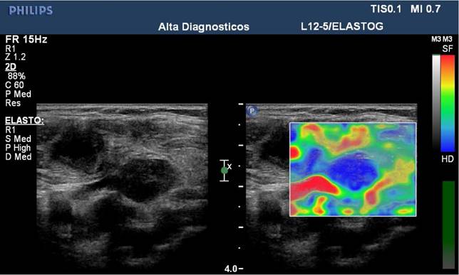 Ultrasound Elastography: Review of Techniques and Clinical Applications