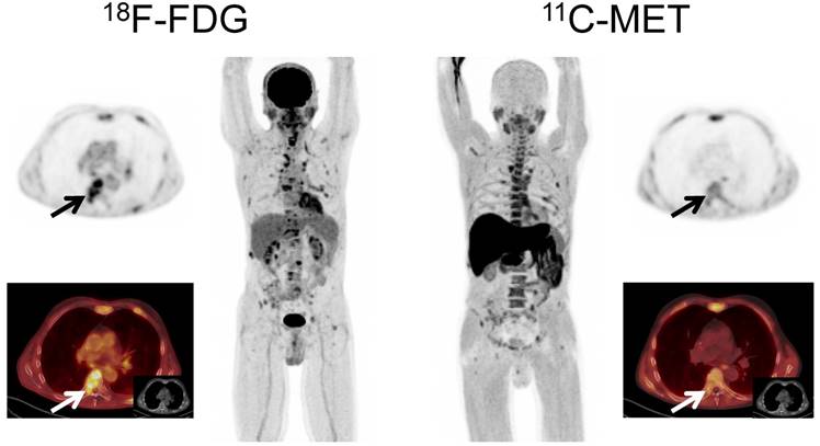 11C-Methionine-PET in Multiple Myeloma: A Combined Study from Two ...