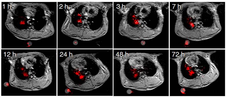 Local Intratracheal Delivery of Perfluorocarbon Nanoparticles to Lung ...
