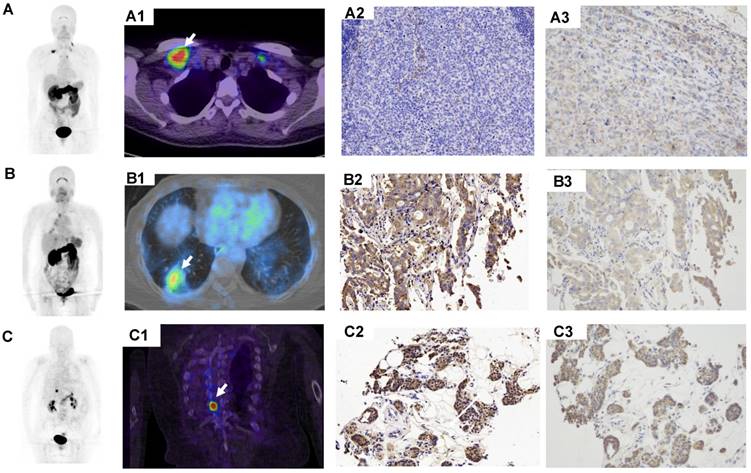 68Ga-BBN-RGD PET/CT for GRPR and Integrin αvβ3 Imaging in Patients with ...