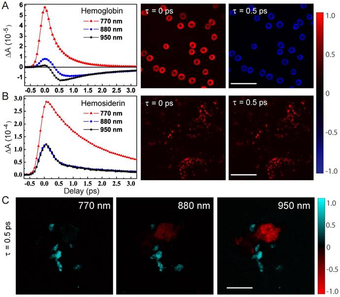 Label-free imaging of hemoglobin degradation and hemosiderin formation ...