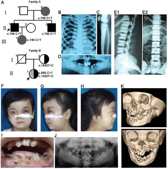 ClC-7 Regulates the Pattern and Early Development of Craniofacial Bone ...