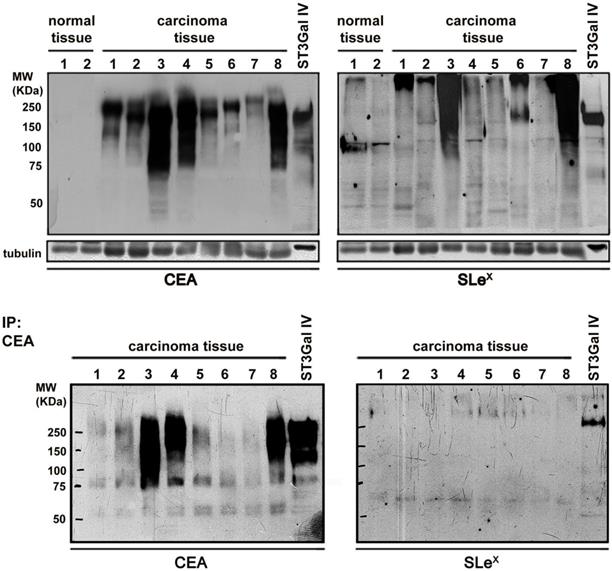 Carcinoembryonic antigen carrying SLeX as a new biomarker of more ...