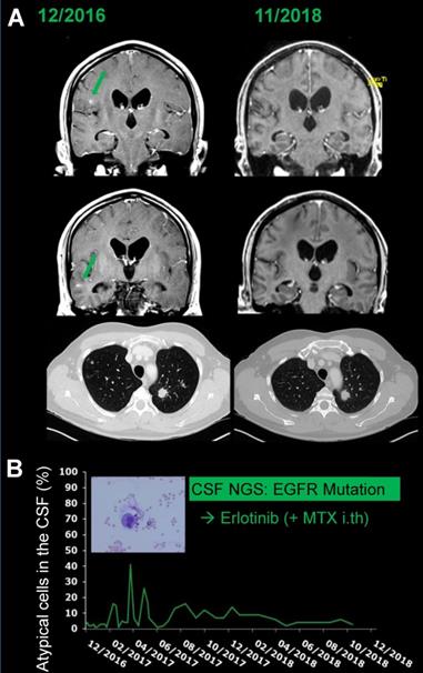 Therapeutic management of neuro-oncologic patients - potential ...