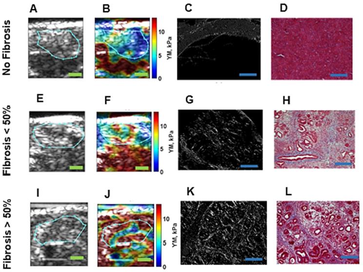 Noninvasive Young's modulus visualization of fibrosis progression and ...
