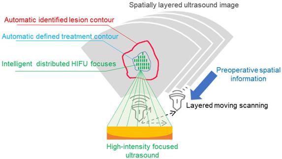 Real-time and multimodality image-guided intelligent HIFU therapy for ...