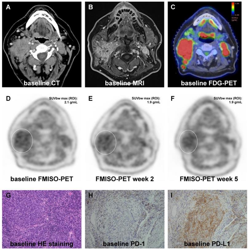 Hypoxia dynamics on FMISO-PET in combination with PD-1/PD-L1 expression ...