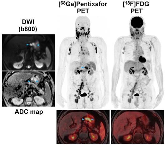 Pet Scan Lymphoma