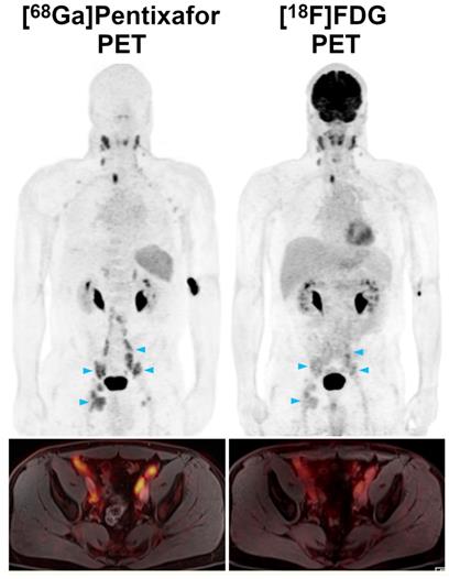 CXCR4 PET imaging of mantle cell lymphoma using [68Ga]Pentixafor ...