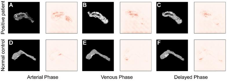 Fully end-to-end deep-learning-based diagnosis of pancreatic tumors