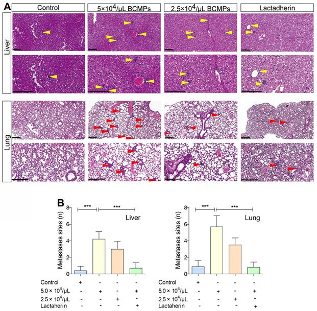 Phosphatidylserine-exposing tumor-derived microparticles exacerbate ...