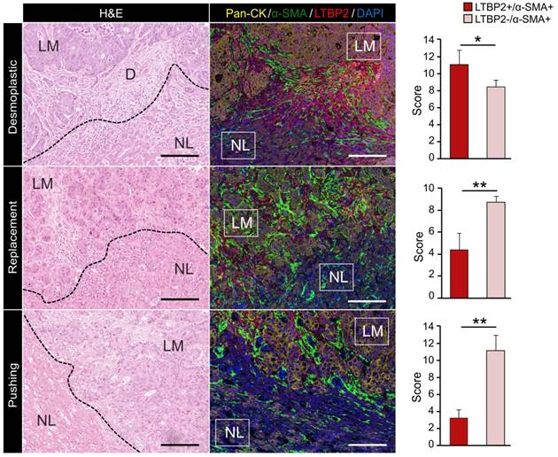The landscape of cancer-associated fibroblasts in colorectal cancer ...