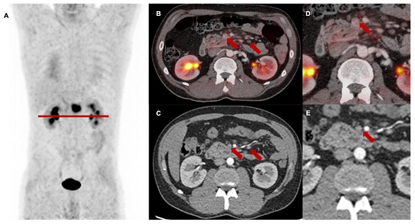 68Ga-labeled fibroblast activation protein inhibitor (FAPI) PET/CT for ...